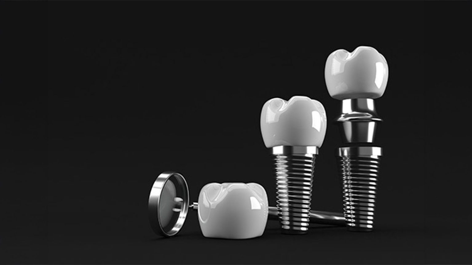 Coronas Dentales | Tratamientos Odontológicos en Madrid